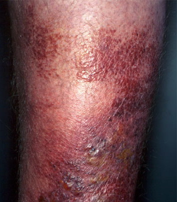 Erysipelas = الحمرة