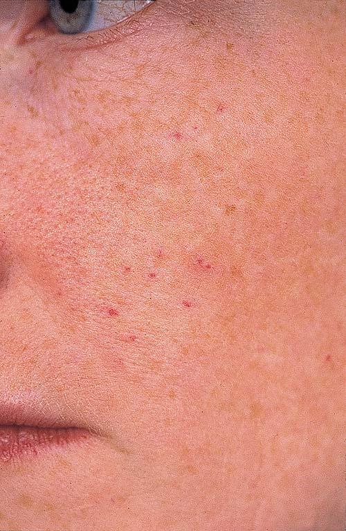 Hereditary Hemorrhagic Telangiectasia Symptoms Causes