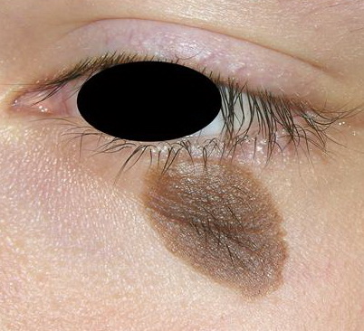 Nevus Pigmentosus
