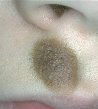 Nevus Pigmentosus