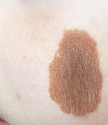 Nevus Pigmentosus