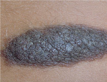 Nevus Pigmentosus