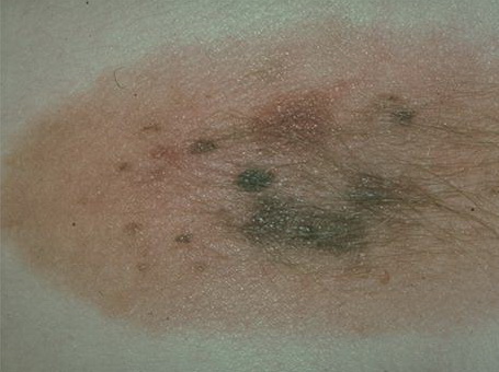 Nevus Pigmentosus