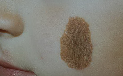 Nevus Pigmentosus