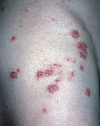 Nummular Dermatitis = التهاب الجلد المدنر أو الاكزيمة المدنرة