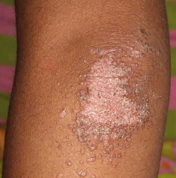 Pityriasis rubra pilaris = النخالية الحمراء الجرابية - Pityriasis rubra ...