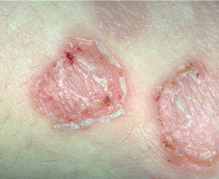 Small Vesicle Impetigo Contagiosa =القوباء السارية ذات الحويصلات الصغيرة