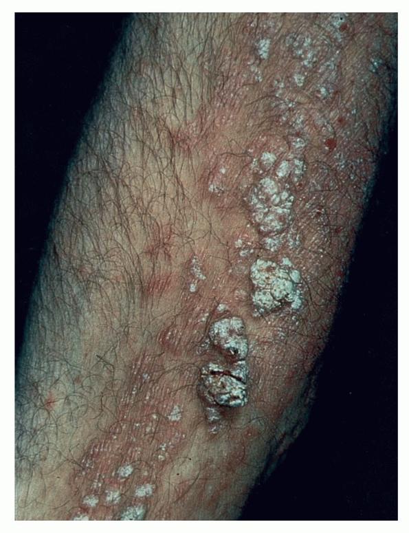 Epidermal Nevus