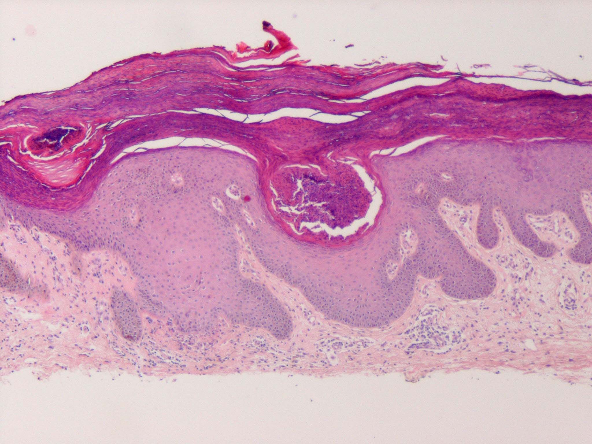Paraqueratose Granular UNIVERSIDADE FEDERAL DO RIO DE JANEIRO CENTRO