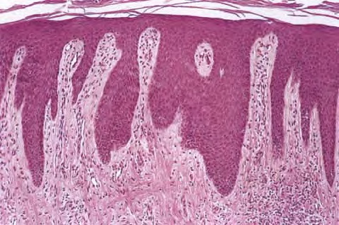Lichen Simplex Chronicus Histology
