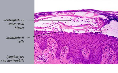 Staphylococcal Scalded Skin Syndrome Causes Symptoms